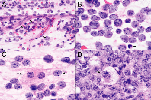 Neural and Primitive Tumors | Neupsy Key