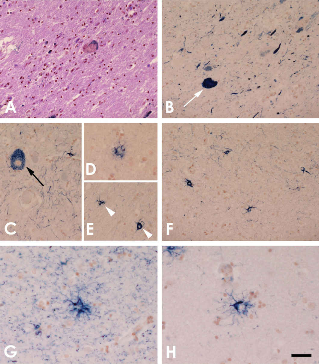 Progressive Supranuclear Palsy | Neupsy Key