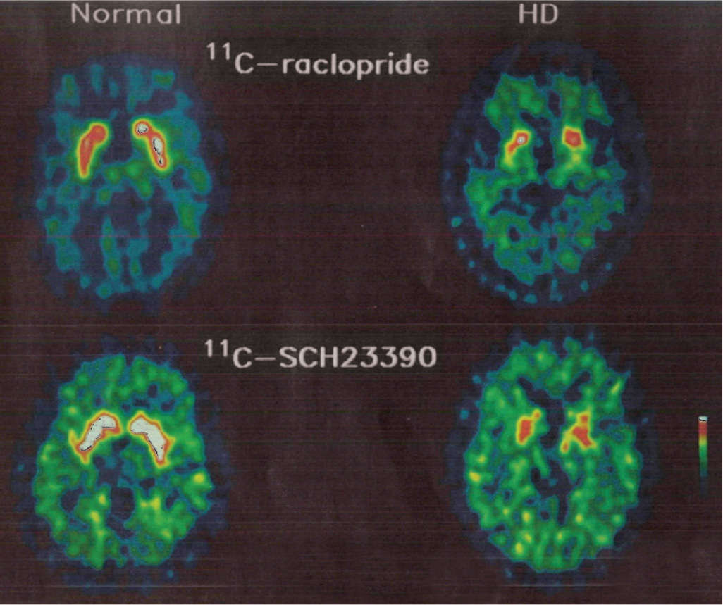Functional Neuroimaging in Movement Disorders | Neupsy Key