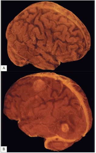 Contrast Enhanced Brain Imaging | Neupsy Key