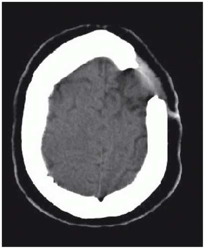 Frontal Lobe Epilepsy | Neupsy Key