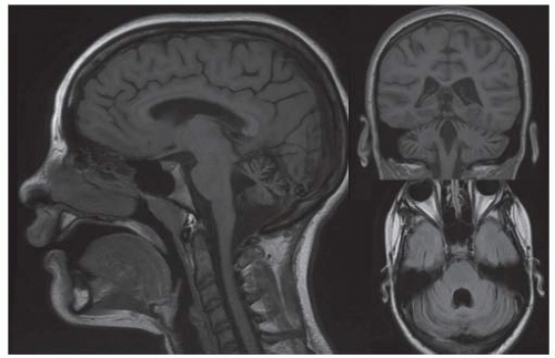 Lipid Storage Ataxia: Niemann-Pick Type C | Neupsy Key