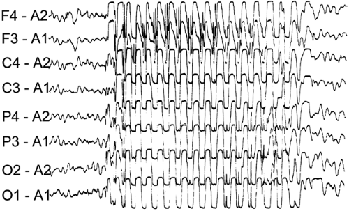 Generalized Convulsive Status Epilepticus | Neupsy Key