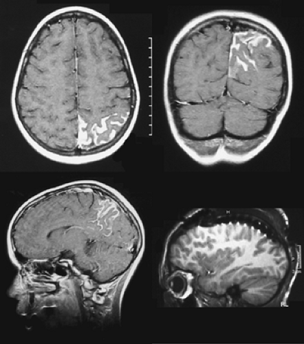 Multilobar Resections and Hemispherectomy | Neupsy Key