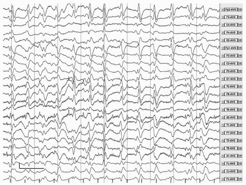 Dementia and EEG | Neupsy Key