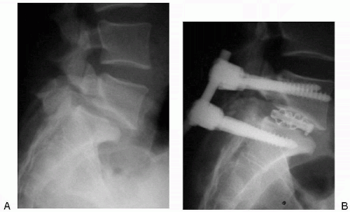 Progression and Surgical Management of Isthmic Spondylolisthesis in ...