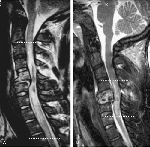 The Neurological Evaluation and Medical Management of Acute Spinal Cord ...