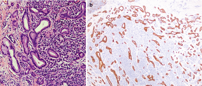 Molecular Pathology of Pancreatic Neuroendocrine Neoplasms | Neupsy Key