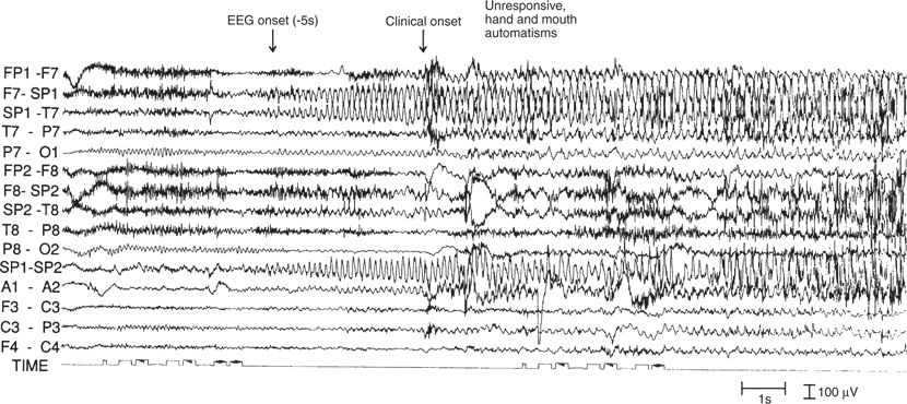 Focal Seizures with Impaired Consciousness | Neupsy Key