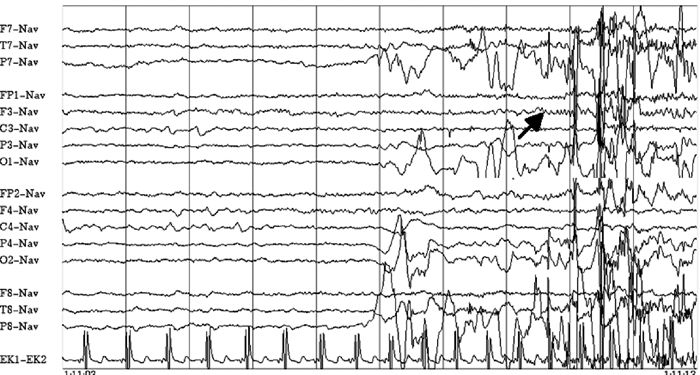 Video–EEG Monitoring in the Presurgical Evaluation | Neupsy Key