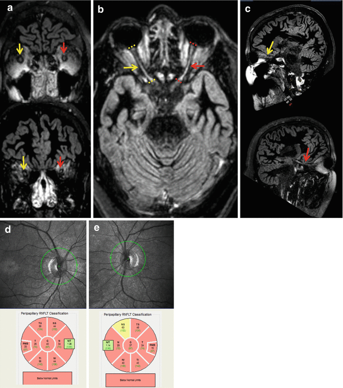 OCT Findings in Neuromyelitis Optica Spectrum Disorders | Neupsy Key