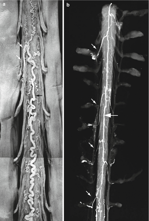 Spinal Vascular Anatomy | Neupsy Key