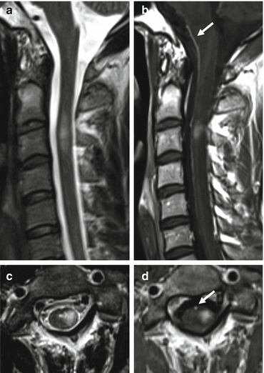 Infectious, Autoimmune and Other Immune-Mediated Causes of Myelitis ...