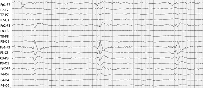 Ictal and Interictal EEG | Neupsy Key