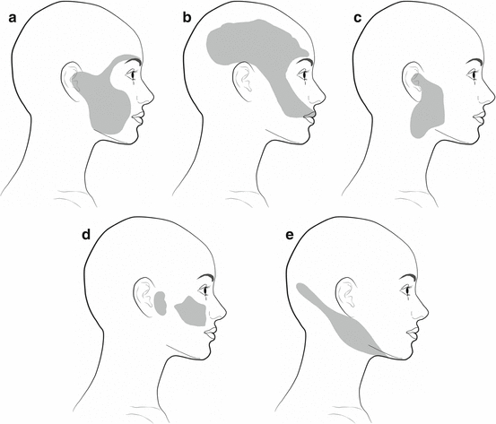 Myofascial Trigger Points Comorbidity in Headache | Neupsy Key