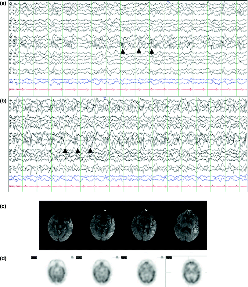 Periodic EEG Patterns | Neupsy Key