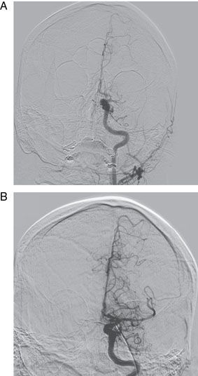 Endovascular Recanalization in Acute Stroke | Neupsy Key