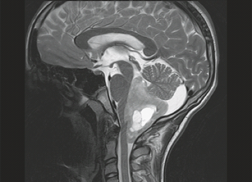 Ependymal Tumors | Neupsy Key