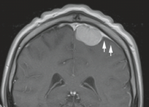 Meningeal Lesions | Neupsy Key