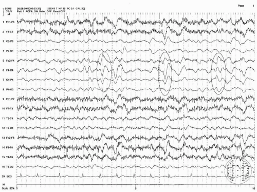 Diffuse EEG Abnormalities | Neupsy Key