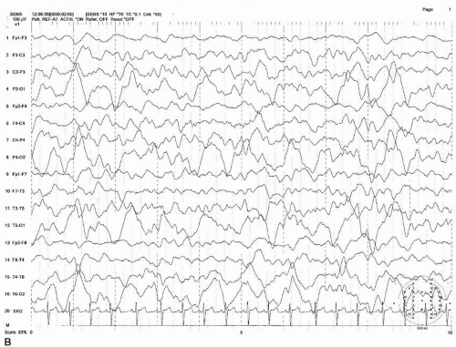Diffuse EEG Abnormalities | Neupsy Key