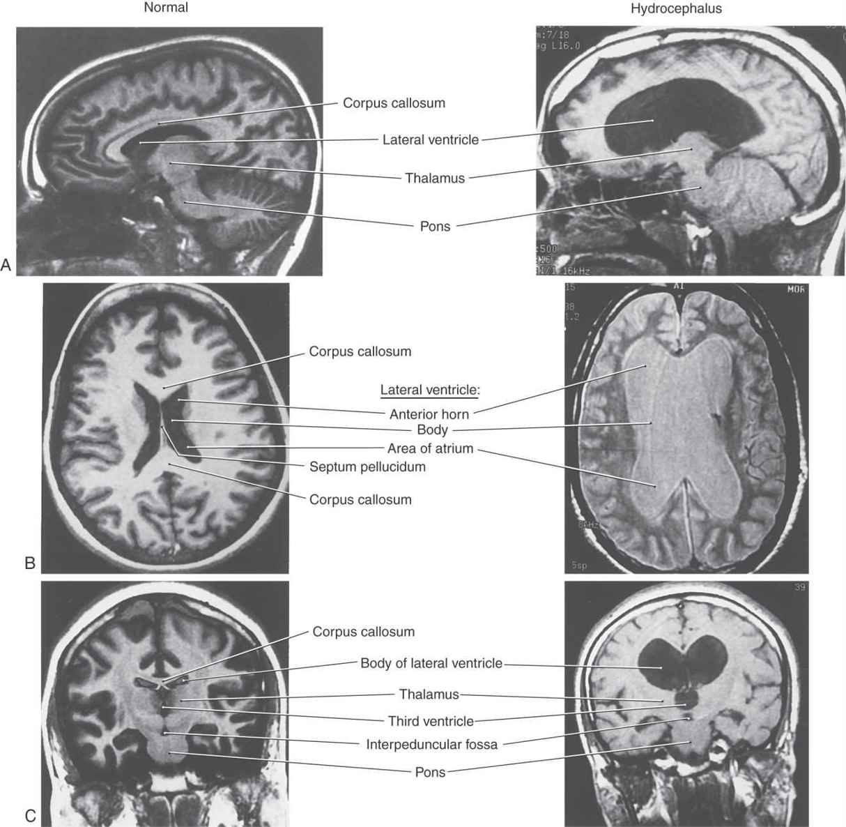 The Ventricles, Choroid Plexus, and Cerebrospinal Fluid | Neupsy Key