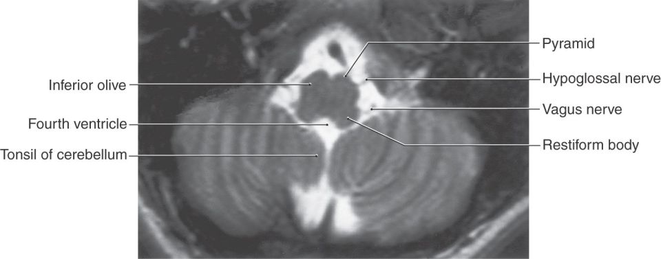 A Synopsis of Cranial Nerves of the Brainstem | Neupsy Key