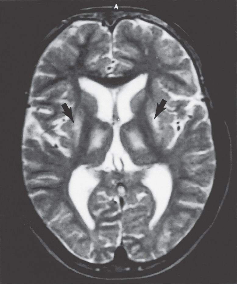 The Basal Nuclei | Neupsy Key