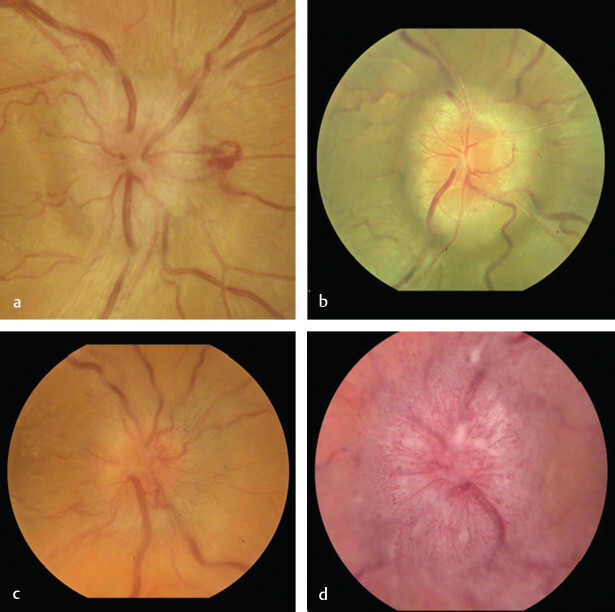5 Neuro-Ophthalmology | Neupsy Key