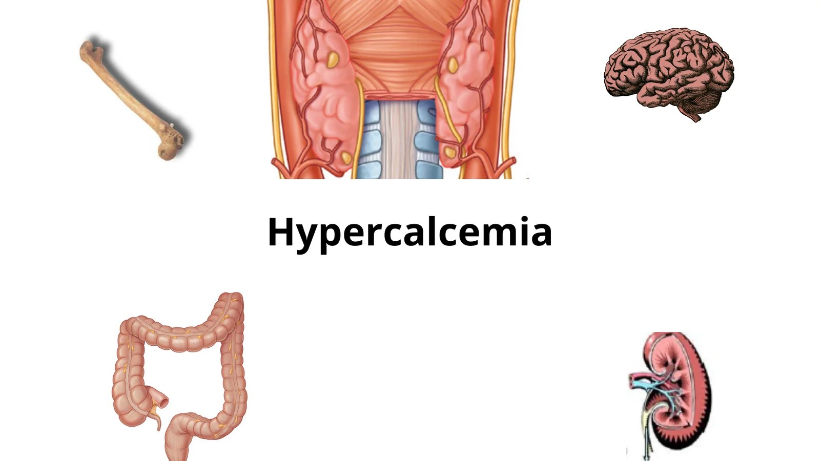 Hypercalcemia: Treatment, Pathophysiology, Symptoms | NotesMed