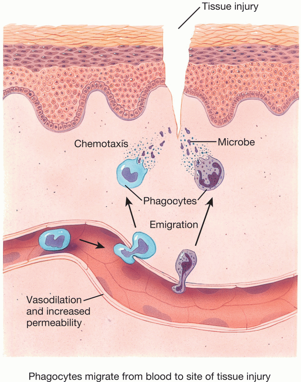 Inflammation, immune response and healing | Nurse Key
