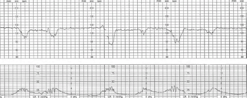 Intrapartum Electronic Fetal Monitoring | Nurse Key