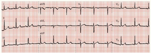 Electrocardiography | Nurse Key