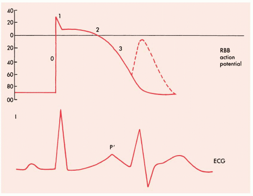 Arrhythmias and Conduction Disturbances | Nurse Key