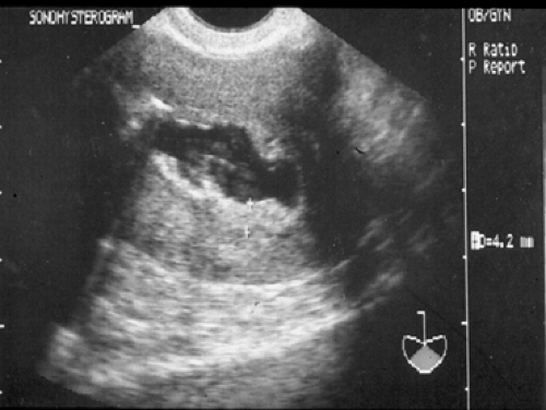Abnormal Uterine Bleeding | Obgyn Key
