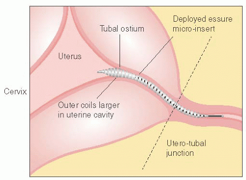Tubal Sterilization | Obgyn Key