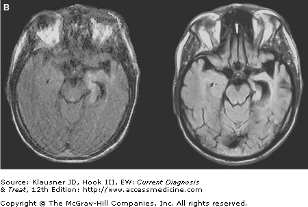 Neurosyphilis | Obgyn Key
