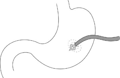 Stomach and Duodenum | Obgyn Key