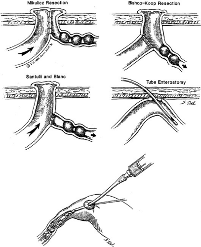 Meconium Syndromes and Cystic Fibrosis | Obgyn Key
