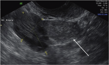 Pregnancy of Unknown Location | Obgyn Key