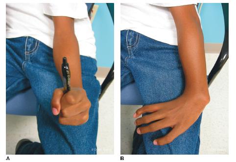 Radial Longitudinal Deficiency | Obgyn Key