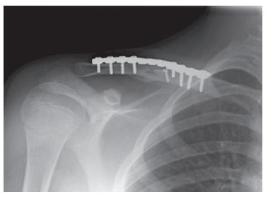 Clavicle Fractures | Obgyn Key
