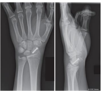 Distal Radius and Carpal Fractures | Obgyn Key