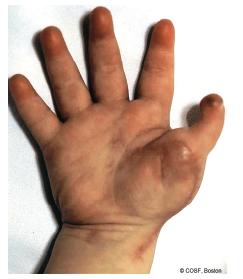 Toe-to-Hand Transfers | Obgyn Key