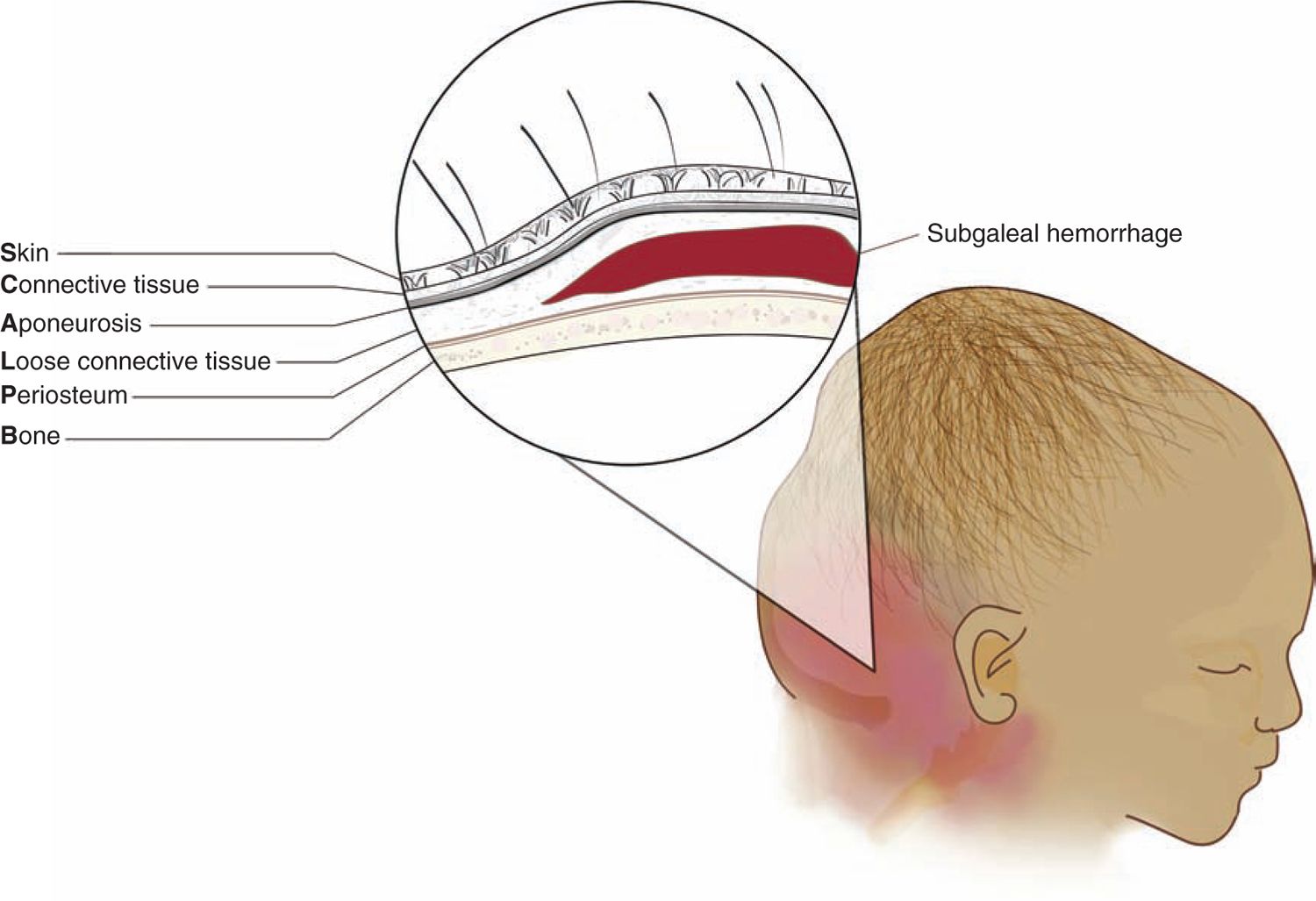 Anemia in the Neonatal Period | Obgyn Key