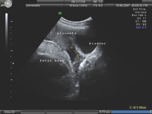 Antepartum Haemorrhage | Obgyn Key