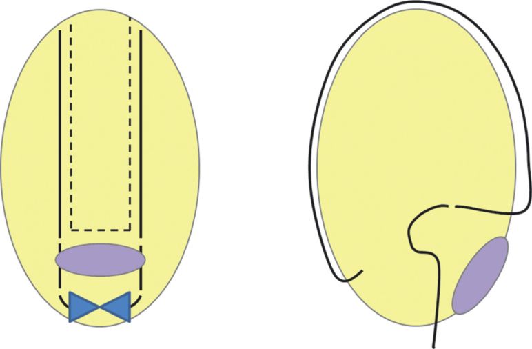Major obstetric haemorrhage | Obgyn Key