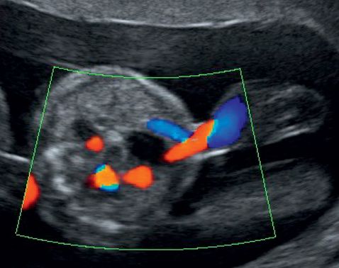 Ultrasound assessment of normal fetal anatomy | Obgyn Key