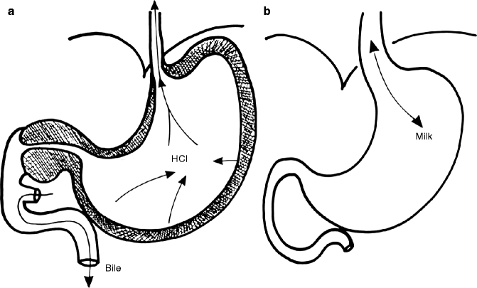 Non-Bile-Stained Vomiting in Infancy | Obgyn Key