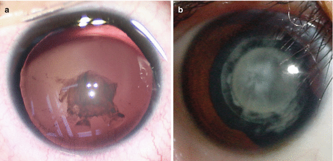 Cataract Surgery in Children with Anomalies of the Uvea | Obgyn Key